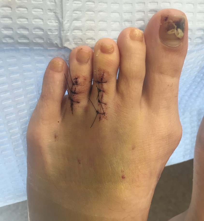 Toe Shortening and Toe Lengthening Surgery – New Cosmetic Foot Surgery ...