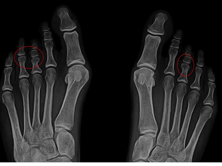 Toe Shortening and Toe Lengthening Surgery – New Cosmetic Foot Surgery ...